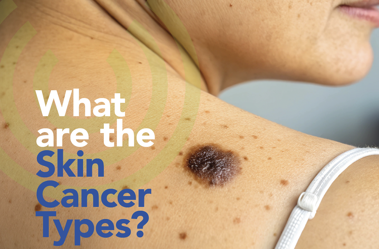 What are Skin Cancer Types - Robert Boissoneault Oncology Institute